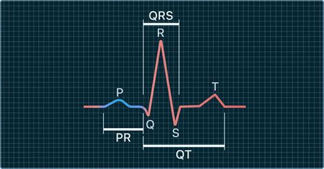 Image result for PR Interval Abnormalities