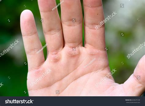 Image result for How to Remove Calluses From Hand