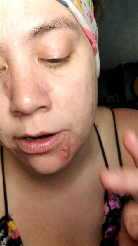 Image result for Exploding Bloody Pimples