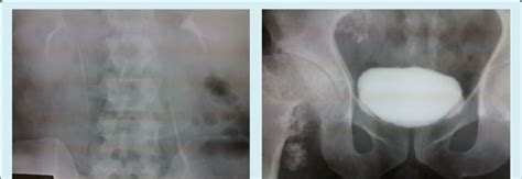 Image result for Urogram Triphasic