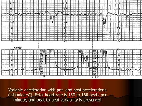Image result for Variable Decelerations