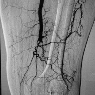 Image result for Left Lower Extremity Angiogram