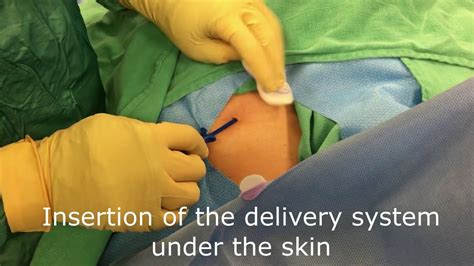 Image result for Loop Recording Device