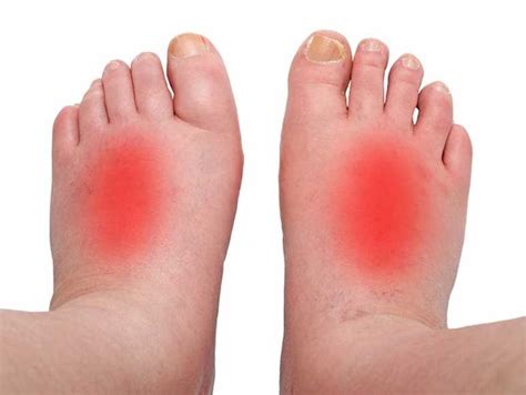 Image result for Cellulitis Toe