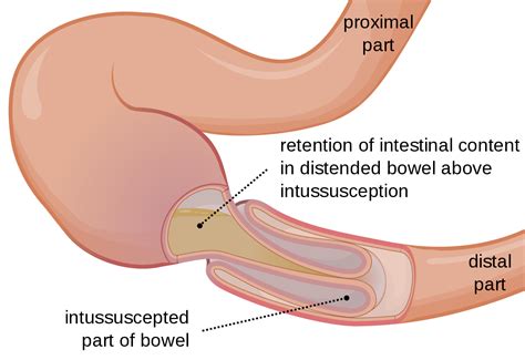 Image result for Intussusception