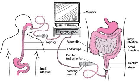 Image result for Endoscopy Small Intestine