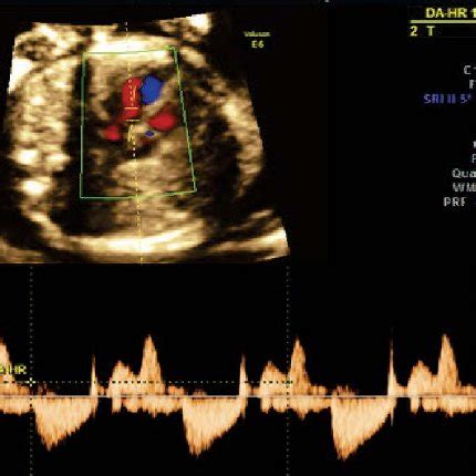 Image result for Normal PR Interval Fetus
