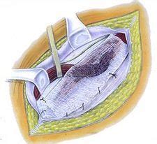 Image result for Open Mesh Repair