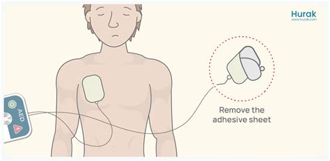 Image result for Remove a Pacemaker and Install Defibrillator