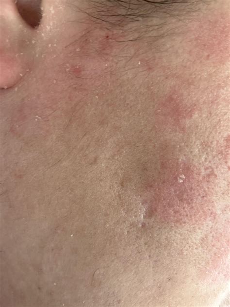 Image result for Seb Derm