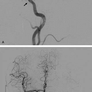 Image result for Angiogram with Embolization