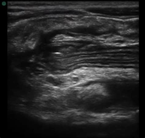 Image result for Intussusception Pseudokidney Sign