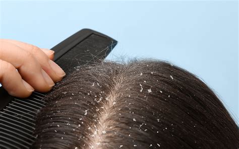 Image result for Seborrhea Capitis