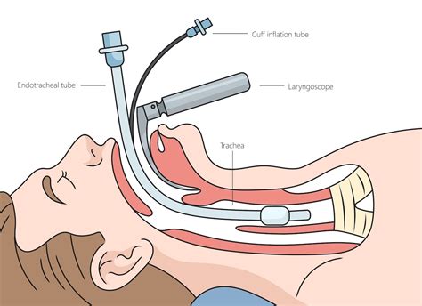 Image result for Intubation Definition