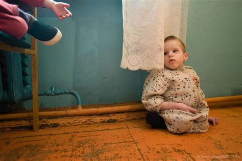 Image result for Birth Defects From Chernobyl Disaster