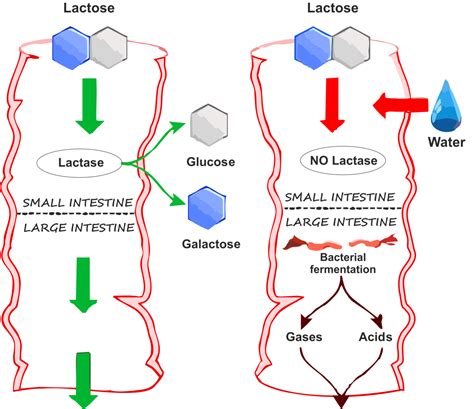 Image result for Lactose Intolerance On Colonoscopy