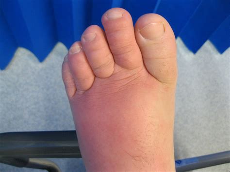 Image result for Cellulitis Toe