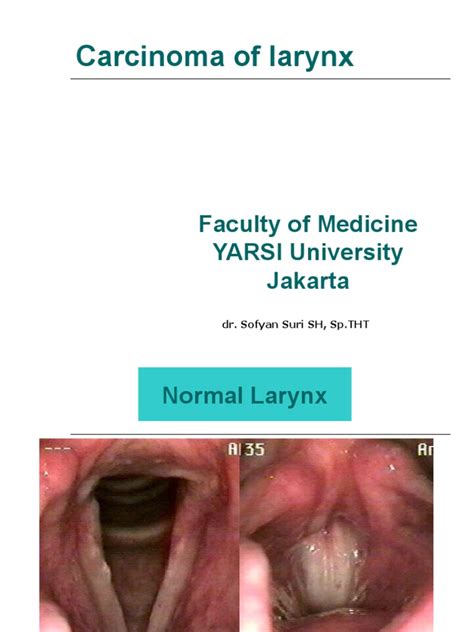 Carcinoma of Larynx: Faculty of Medicine YARSI University Jakarta | PDF ...