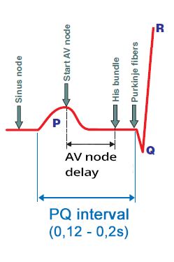 Image result for AV Block PR Interval