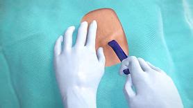 Image result for Loop Recorder Surgery