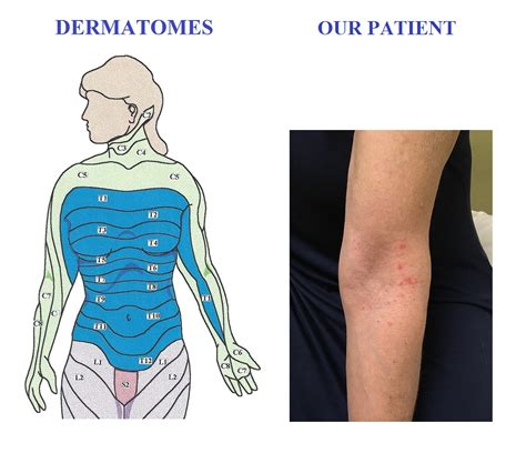 Image result for Shingles On Arm