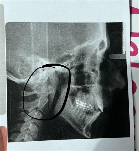 Image result for Normal Neck Rotation