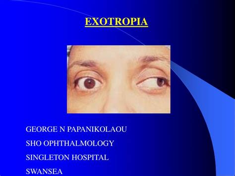 Image result for Exotropia and Computer