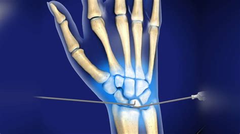Image result for Wrist Arthrogram