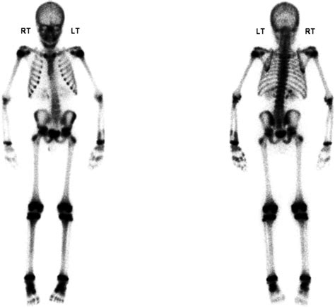 Image result for Triple Phase Bone Scan