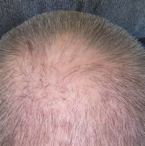 Image result for Seb Derm