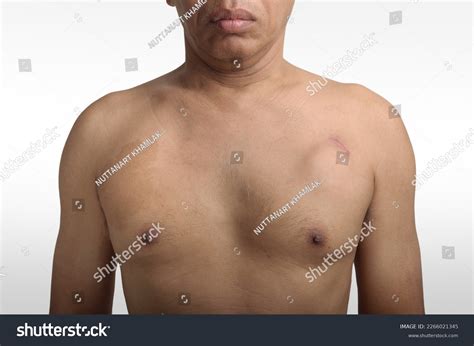 Image result for Recovery After Pacemaker Surgery