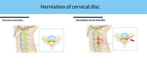 Image result for Cervical Steroid Injection