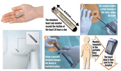 Heart Holter Monitoring to Diagnose Palpitations - Get Help