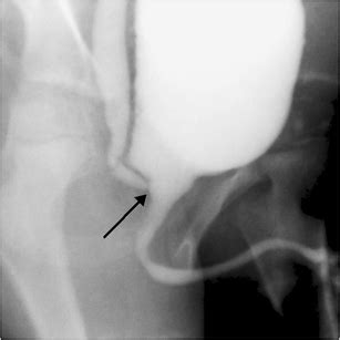 Image result for Voiding Cystourethrogram GIF