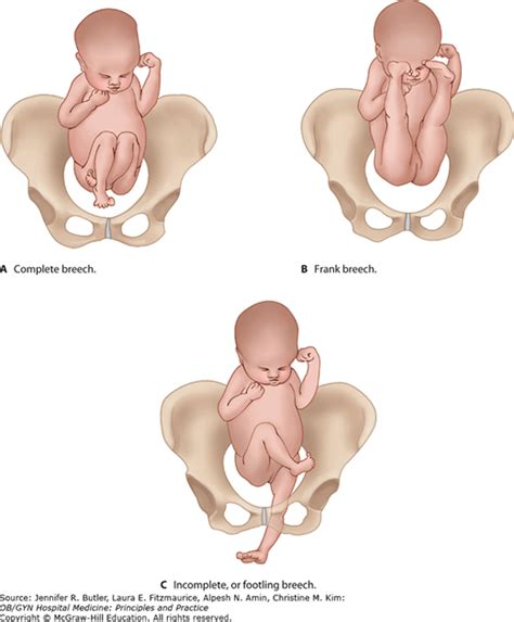 External Cephalic Version | Obgyn Key