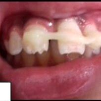Splinting of the avulsed tooth with fibre reinforced composite resin ...