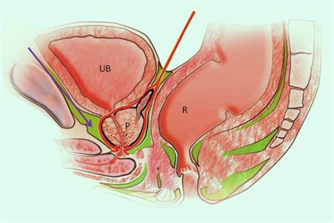 Image result for Simple vs Radical Prostatectomy