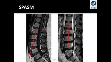 Image result for Mid-Back Muscle Spasm