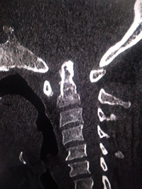 Image result for X-Rays for Basilar Invagination