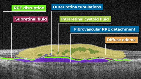 Image result for Oct Interpretation