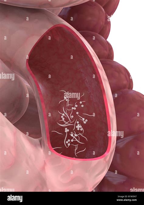 Image result for What Is Pinworm