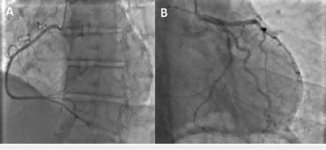 Image result for Normal Coronary Angiogram
