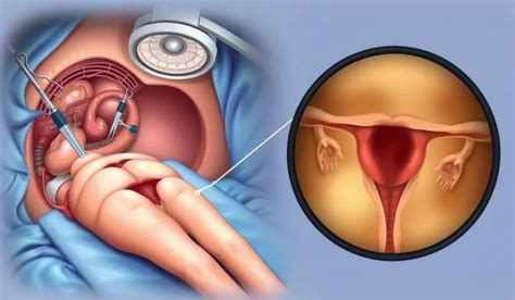 Image result for Upper-Back Cyst Surgery