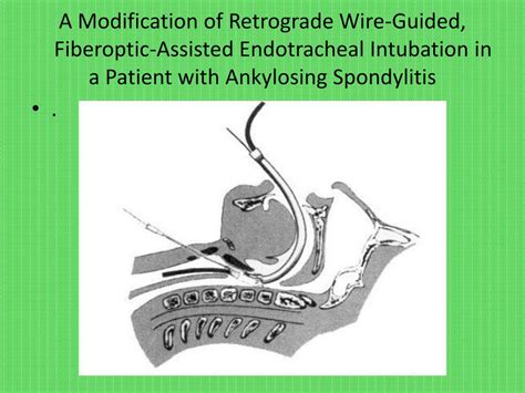 Image result for Retrograde Intubation