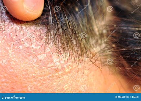 Image result for Seborrhea Capitis