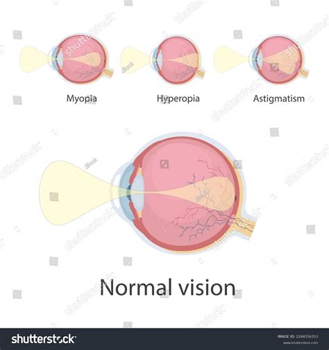 Image result for Vision Defects Myopia