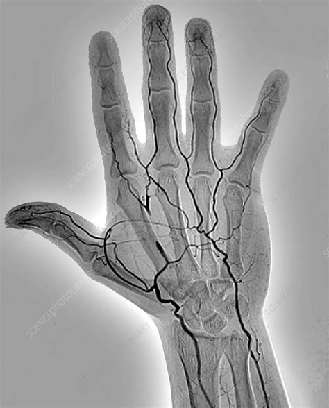 Image result for Hand Angiogram