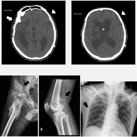 Image result for Triple Phase Bone Scan