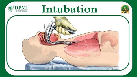 Image result for Intubation Real