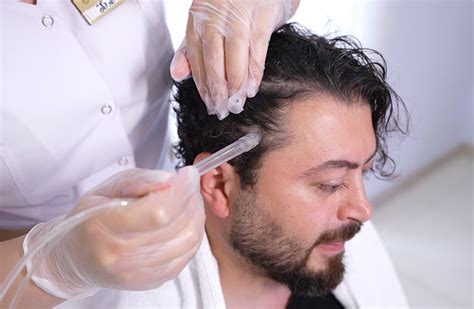 Image result for Treating Seborrhea